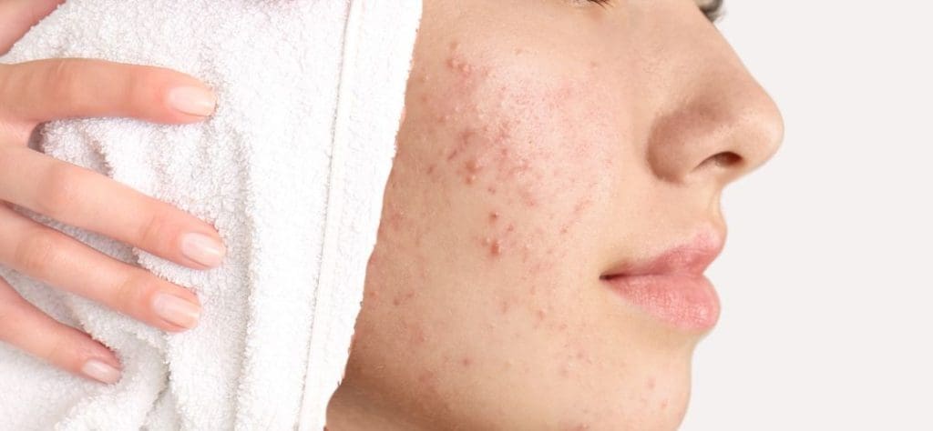 acne | TARAMAR | Discover the purest NoTox skincare in Iceland